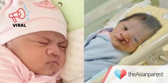 "Hindi Ko Ikinakahiya Ang Baby Ko Na May Bingot."