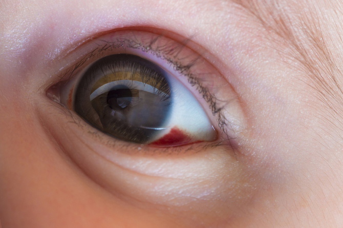 Subconjunctival Hemorrhage: Why Your Newborn Has Bloodshot Eyes
