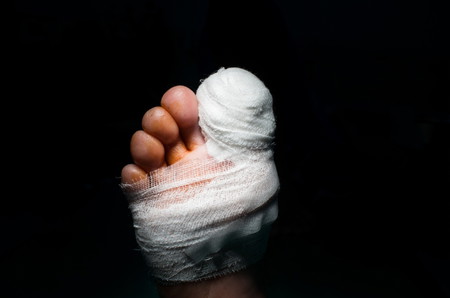 Sugat Sa Paa: Sanhi, Sintomas, Gamot At Home Remedy