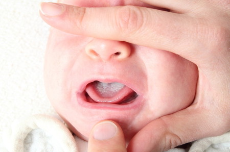 Epstein pearls in infants: what causes and how to treat?