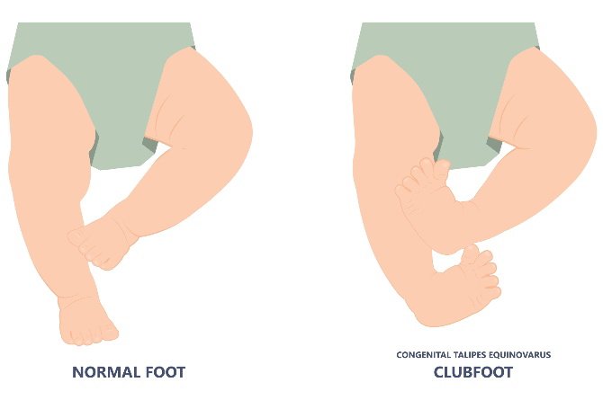 Does Your Baby Have Clubfoot? Check Out These 5 Symptoms