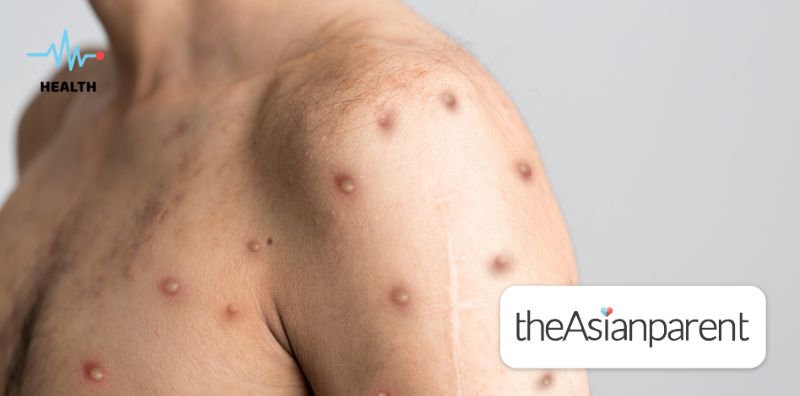 DOH Philippines Handa sa Monkeypox Outbreak | theAsianParent