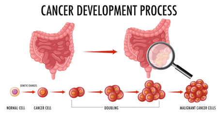 Colon Cancer Symptoms: Sanhi, Sintomas, At Lunas