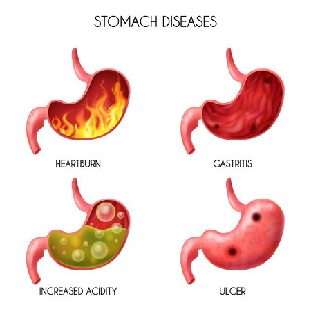 Gamot Sa Ulcer: Ano Ang Sintomas Nito At Paano Ito Maiiwasan?