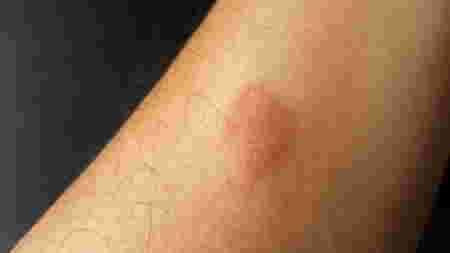 Kagat ng Alupihan: Paunang lunas, sintomas, at epektibong Gamot