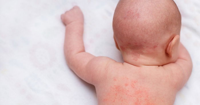 Heat Rash in Babies: Causes, Symptoms, and Prevention Tips