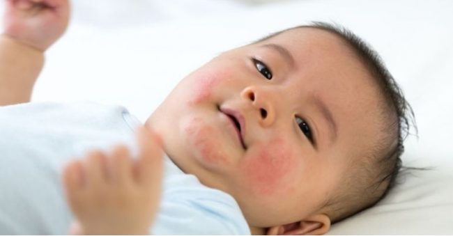 Get to Know Erythema Toxicum Neonatorum