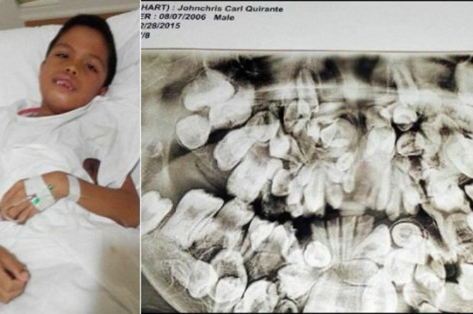 This 9-year-old Boy Needs 7 Surgeries To Extract 300 Teeth