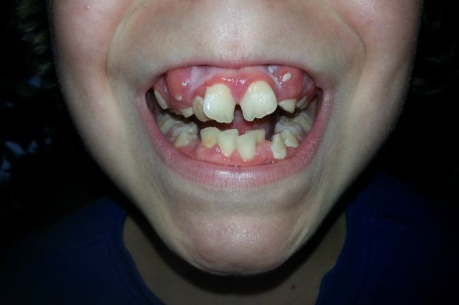 Boy With Rare Teeth Condition Stops Smiling After He Was Bullied