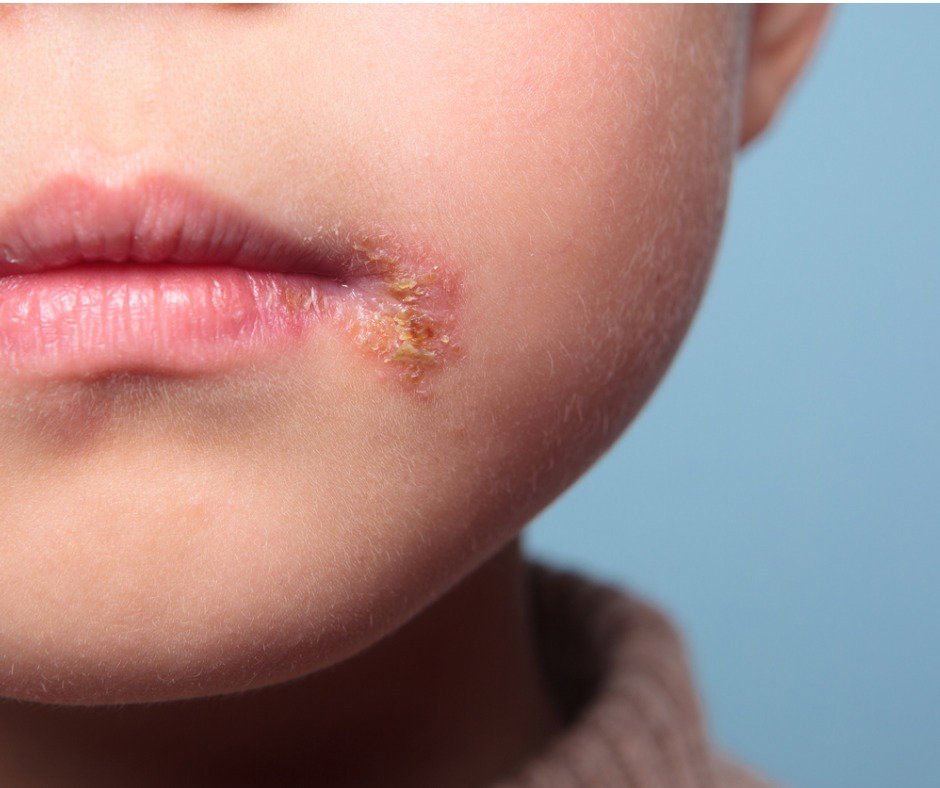 “A Cold Sore Killed Our Newborn Baby,” Grieving Parents Say
