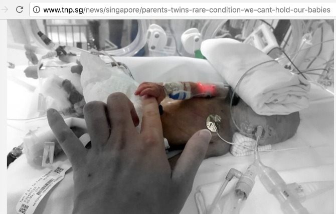Twin To Twin Transfusion Syndrome Treatment: This Baby Is Back Home!