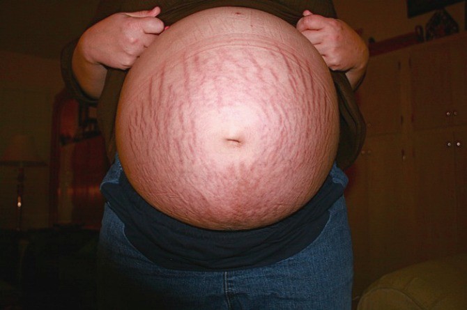 STRETCH MARKS - Clifford Clinic has a Solution for your Stretch Marks