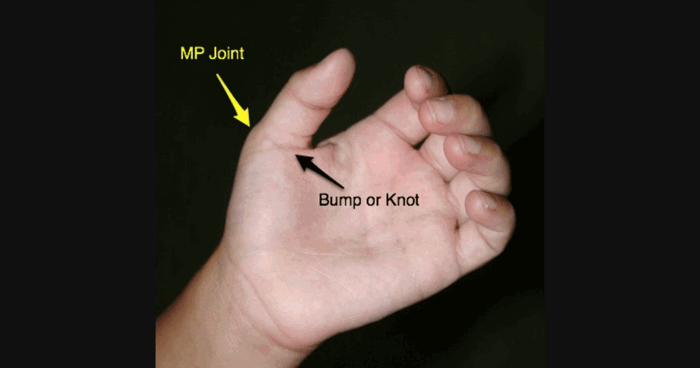 This Singapore Toddler Has Trigger Thumb And Here's What It Means!