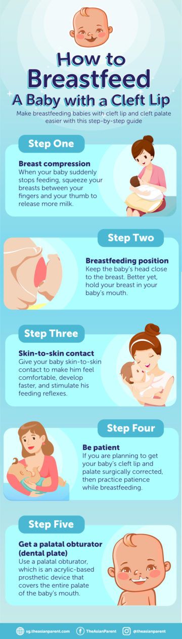 Cleft Palate Feeding Techniques And More About Cleft Lip And Palate