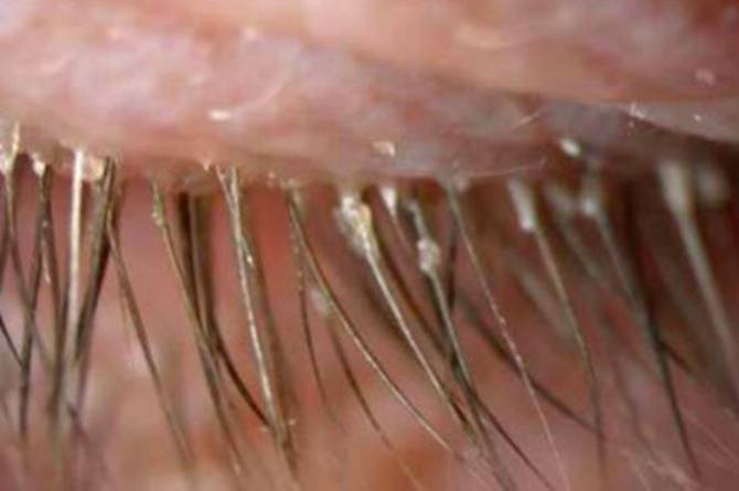 Over 100 Eye Parasites Caused This Woman's Eye Itching And Redness