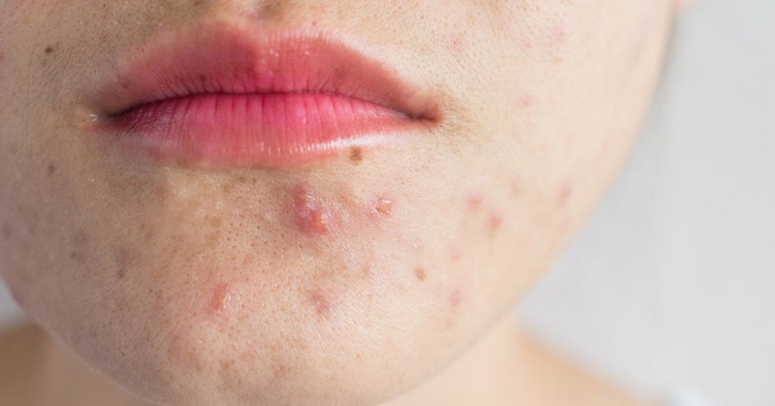 Preteen Acne: All That You Need To Know About The Causes, Treatment And ...