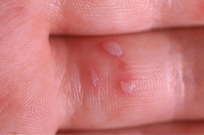 Ringworm On Finger