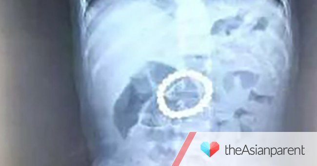 Dangers of Magnetic Toys: Toddler Swallows 21 Magnetic Beads