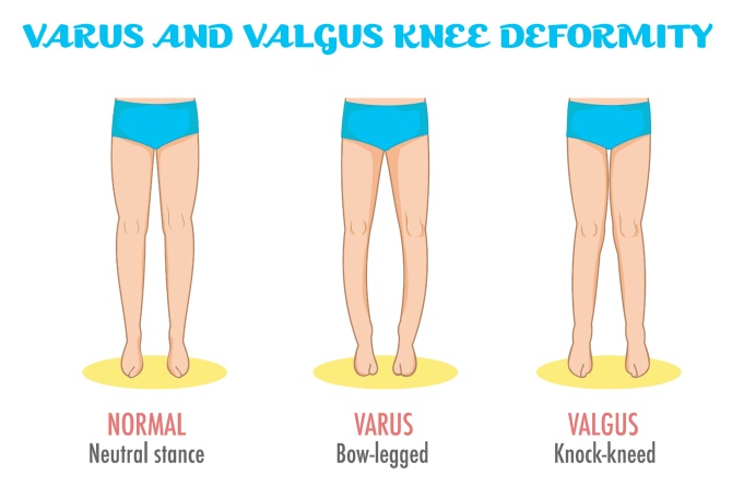 Bow Legged Women