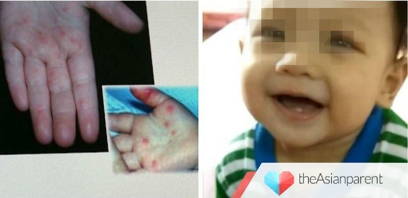 New Strain Of HFMD EV-71 And What Parents Should Know About It