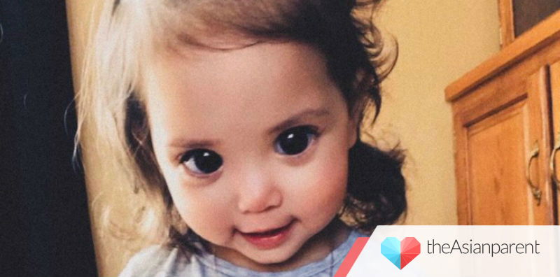 Axenfeld Rieger Syndrome Eye Disease Gives Girl, Aged 2, Beautiful Eyes