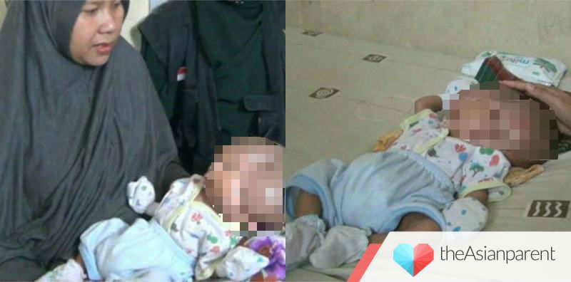 Baby With 2 Faces Born In Indonesia, Needs Funding For Surgery