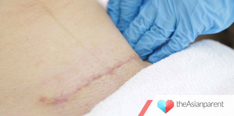 Signs Of Infection After C Section All Expecting Mums Should Know