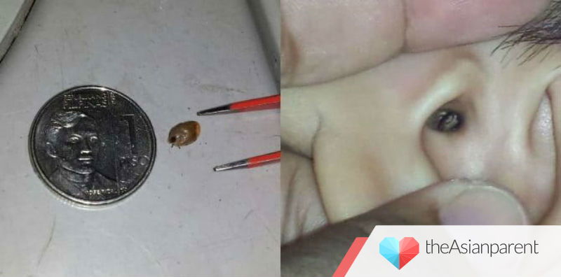 Signs Of Tick In Ear All Parents Should Know About!