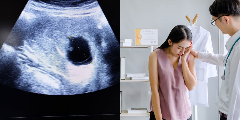 Anembryonic Pregnancy: What Is A Blighted Ovum