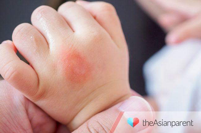 How to Handle Allergies in Kids - A Parent’s Guide to Prevention and Care