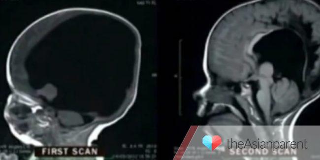 Born With No Brain But "Grew" 80% Of His Brain Back At Three Years Old