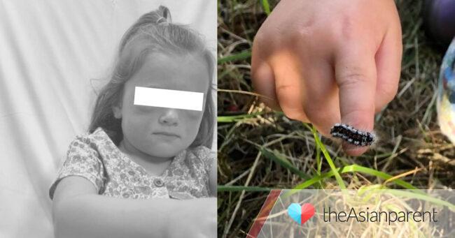 Allergic Reaction From Touching Caterpillar: A Mum's Warning