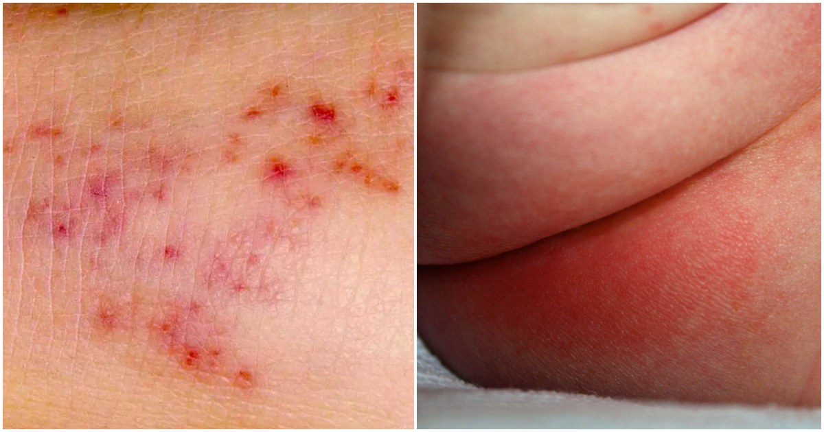 Ulcer Skin Rash In Toddlers 11 Common Rashes On Kids And Preschoolers
