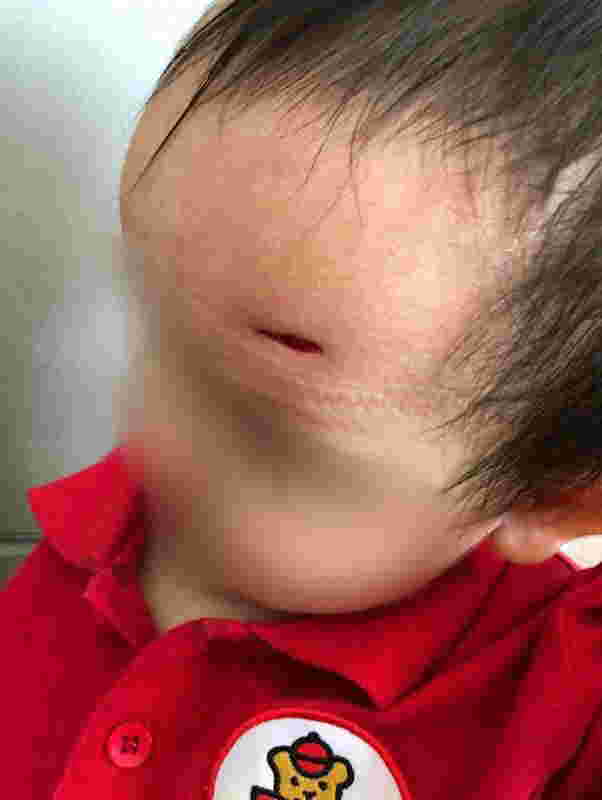 Maplebear Moulmein Incident: Toddler Ends Up With Cut On Forehead
