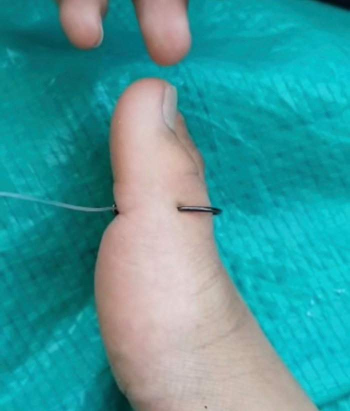 Girl Steps On Fishing Hook At East Coast Park That Pierced Into Her Toe