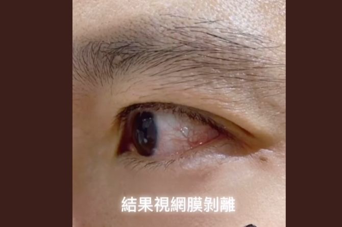 Eye Injuries First Aid Options: Why Keeping Your Eyes Safe is Important