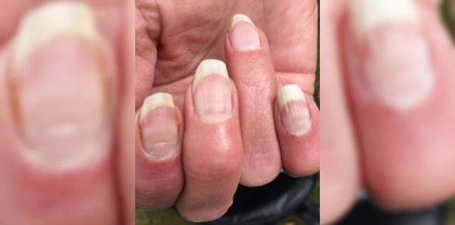 Covid Nails Could Indicate That You Were Infected