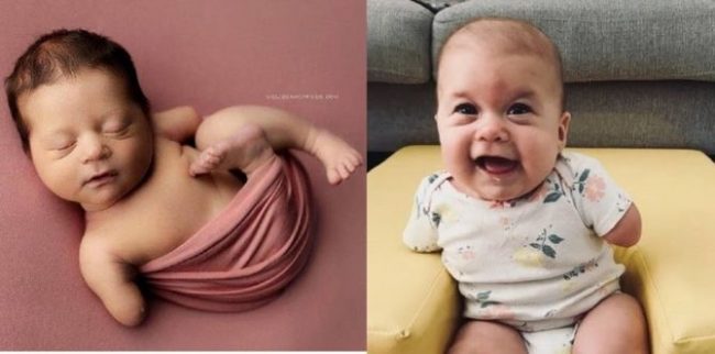 Congenital Hand Deformities: "The Baby Had No Arms & Hands"