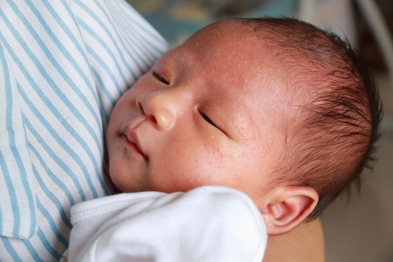 Baby Acne: Everything Parents Need To Know About Newborn Acne