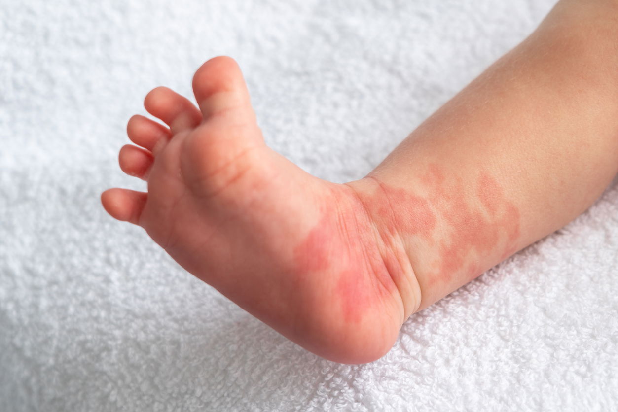 Decoding Your Baby's Birthmark: A Guide for Concerned Parents