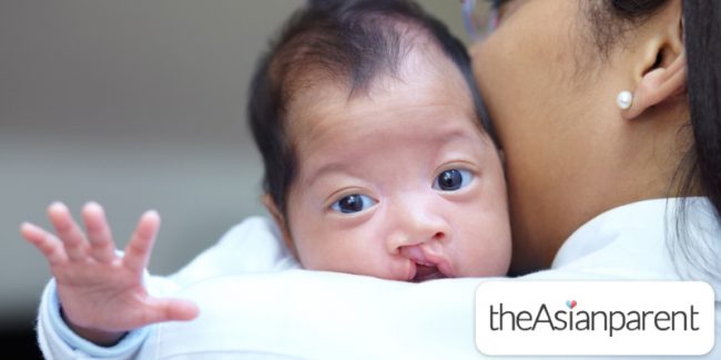 Cleft Palate: Everything You Need To Know