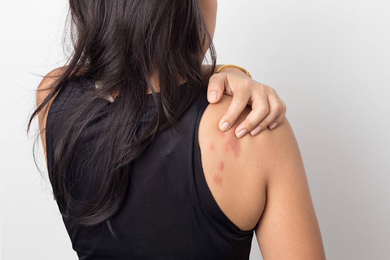 Urticaria: Causes, Symptoms and How to Relieve the Itch
