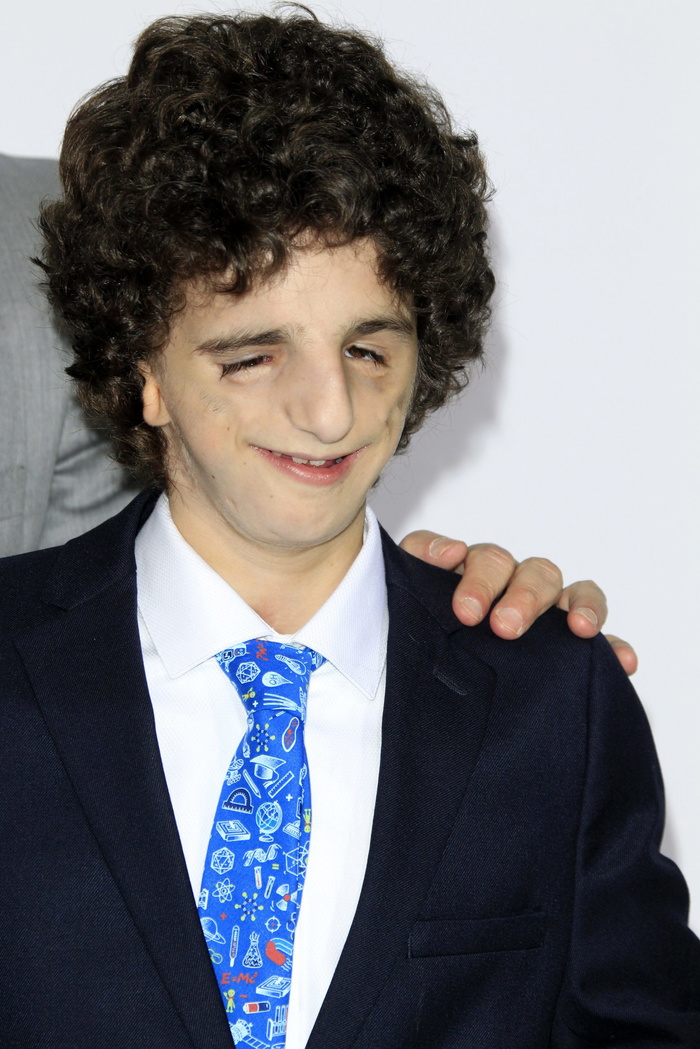 Treacher Collins Syndrome Causes Symptoms And Treatment