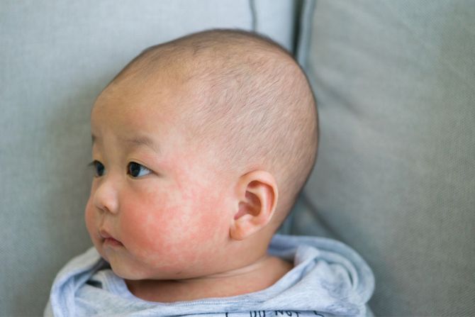 Atopic Dermatitis in Kids: What Every Parent Should Know