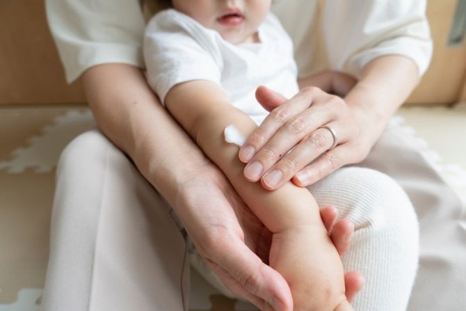 From Tears to Cheers: A Mother's Journey with Her Baby's Eczema