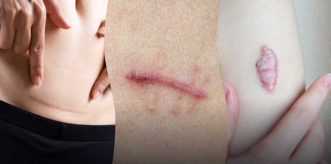 How to Care for Postpartum and Surgical Scars