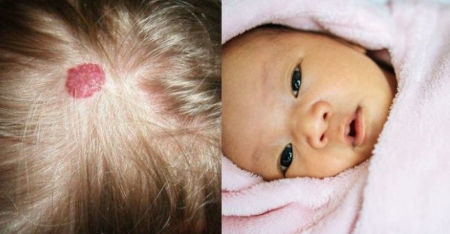 Get to Know Hemangioma, aka Red Spots on Baby's Skin, Are They Dangerous?
