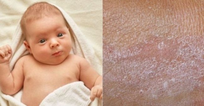 Epidermolysis Bullosa: Symptoms, Risk Factors, and Prevention