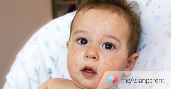 Sepsis in Babies: Causes, Symptoms, and How to Prevent It