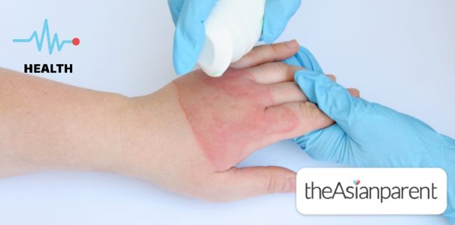 What is the medicine for a child who gets burned?